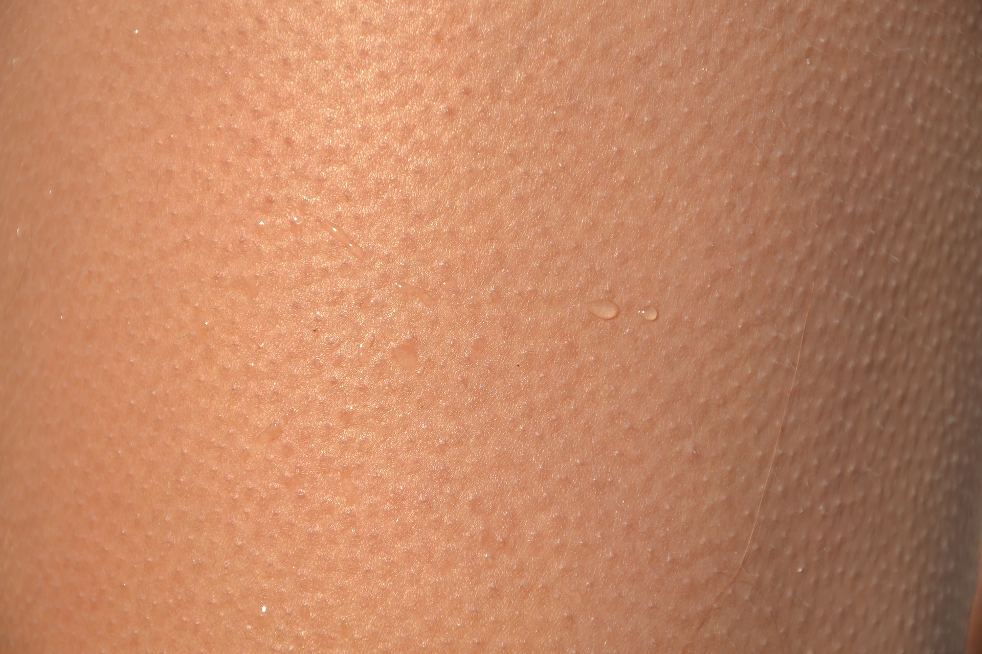 Neišgydomas ir neišvengiamas atopinis dermatitas: svarbi bakterijų ...